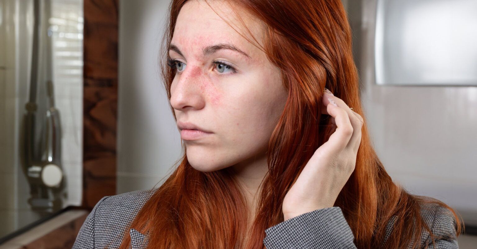 Best Products for Rosacea in Australia - Experience Beauty